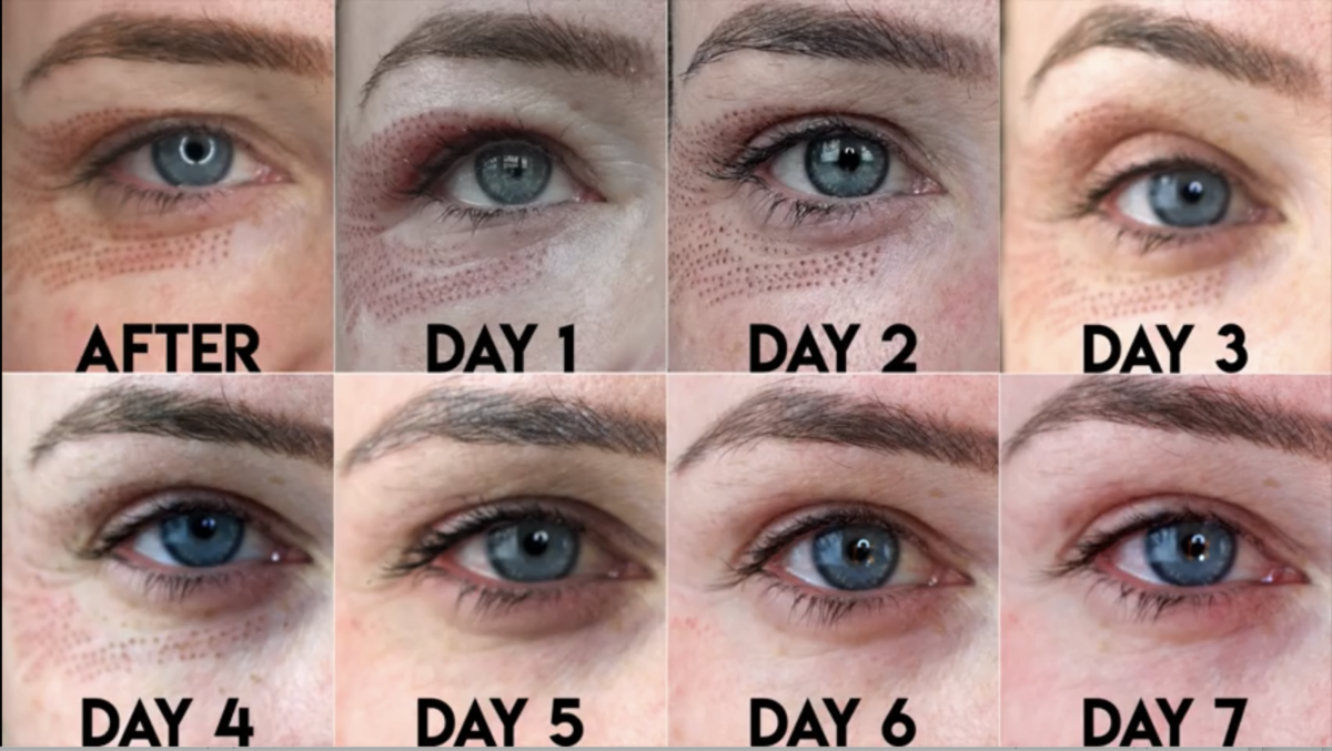 Aesthetics Hawaii is pleased to introduce the PLEXR Plasma Pen ...